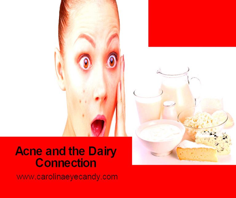 Acne And Its Dairy Connection | Carolina Eye Candy